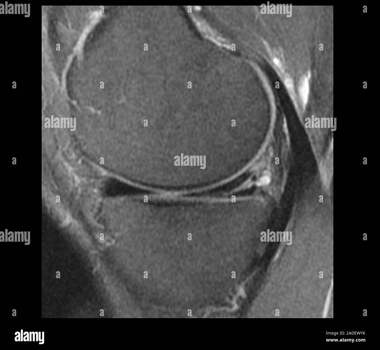 Knee meniscus injury. Magnetic resonance imaging (MRI) scan of a ...