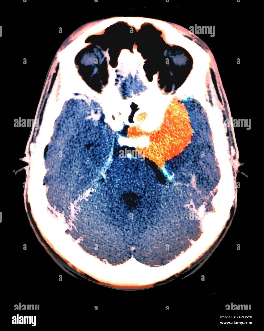 Brain tumour. Coloured computed tomography (CT) scan of an axial section of the brain of a 44 ...