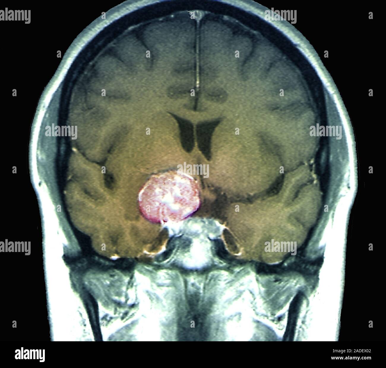 Brain tumour. Coloured magnetic resonance imaging (MRI) scan of a ...