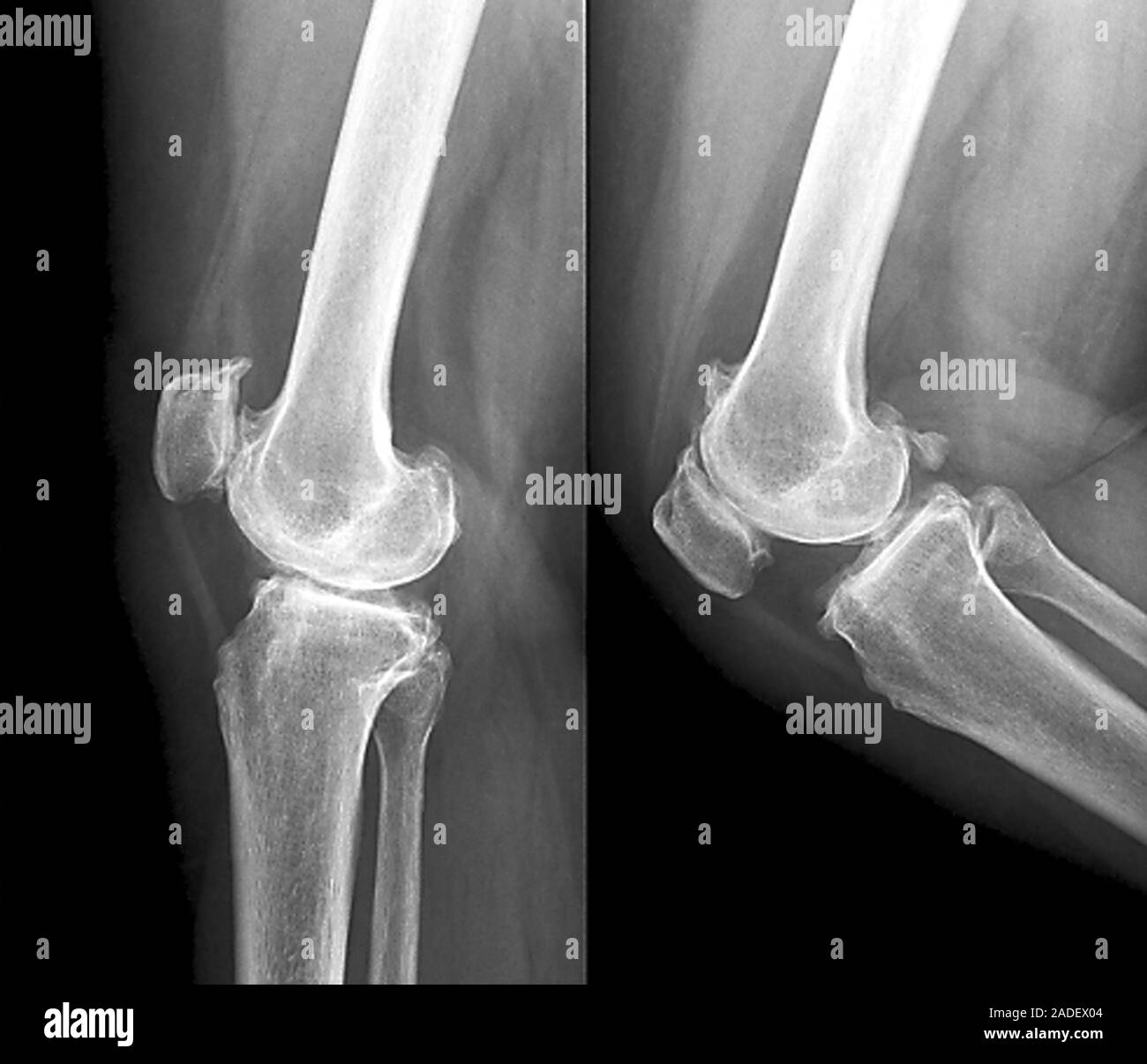 Osteoarthritis of the knee. X-rays of the right knee of a 55-year-old ...