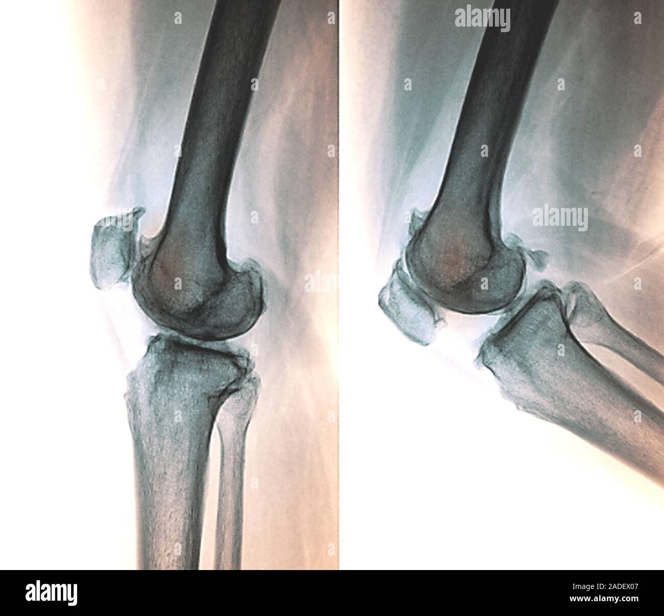 Osteoarthritis of the knee. Coloured x-rays of the right knee of a 55 ...