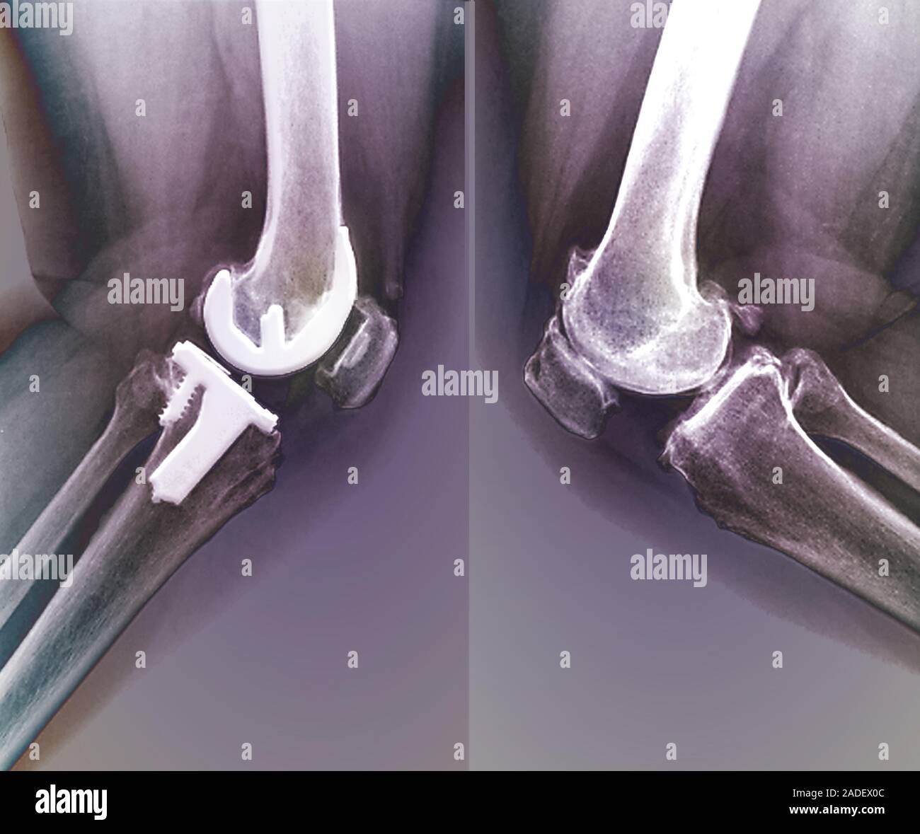Knee osteoarthritis and total knee replacement. Coloured x-rays of the ...