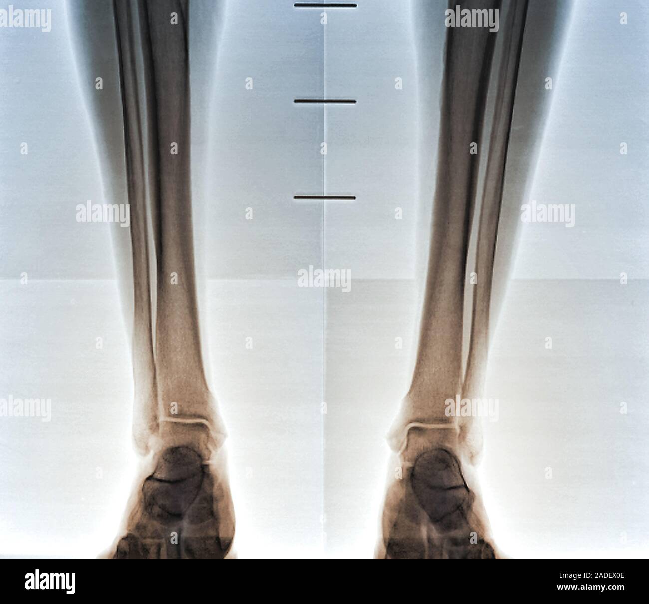 Healthy lower legs. Coloured x-ray of the lower legs of a standing 52 ...