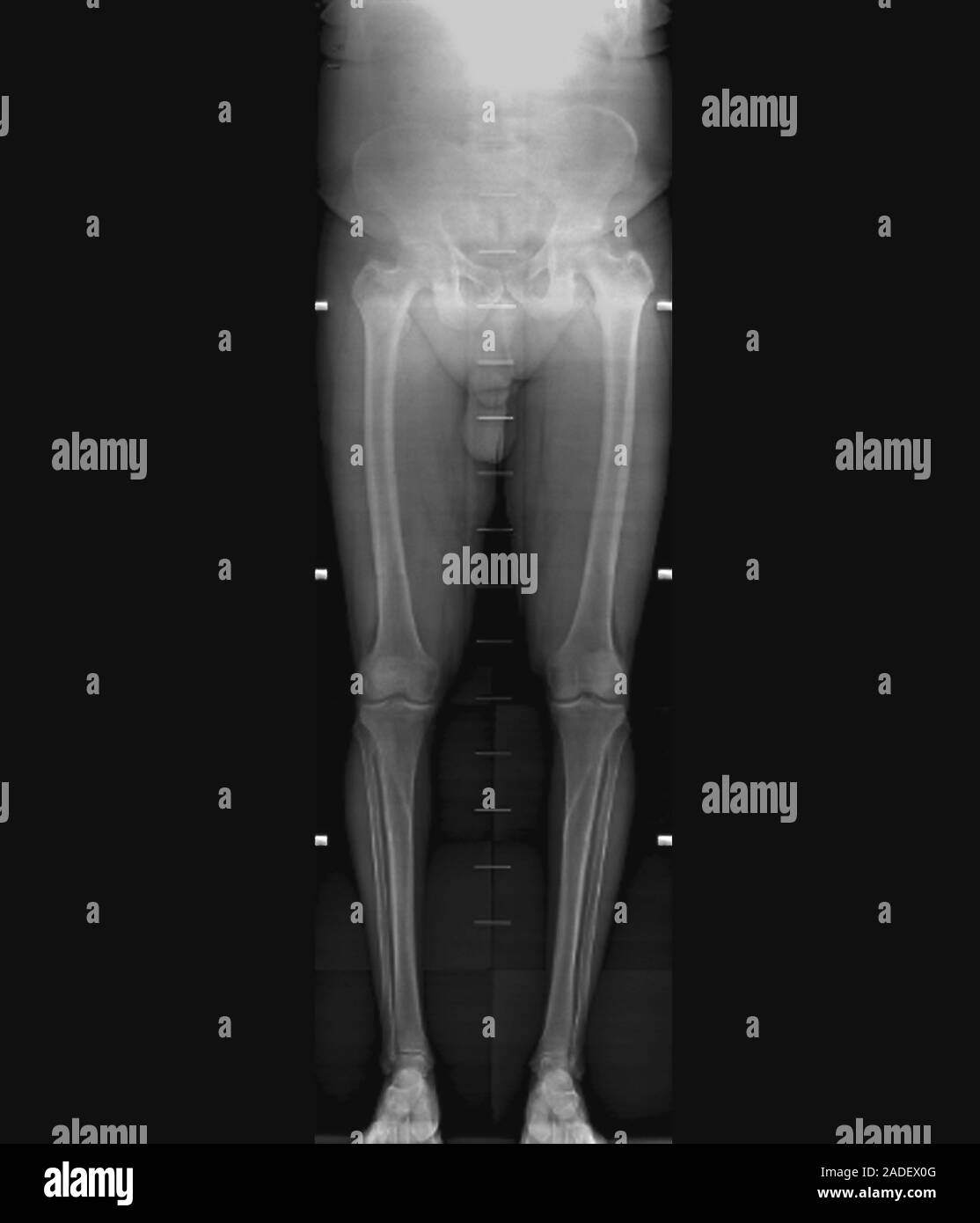 Healthy lower body. Frontal x-ray of the healthy lower body of a ...