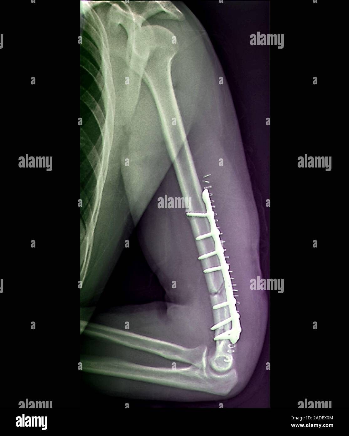 Fixed upper arm fracture. Coloured x-ray of a section through the left ...