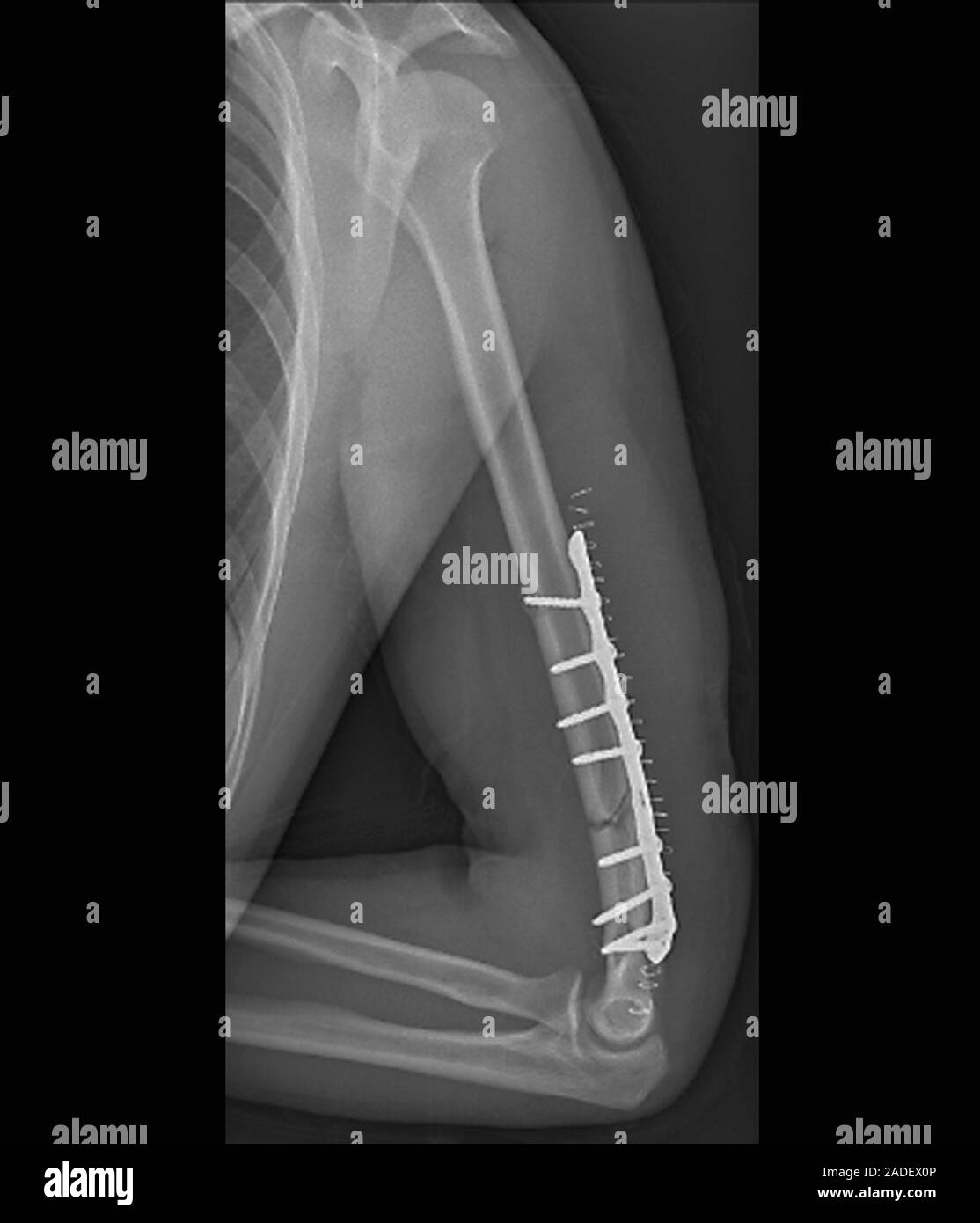 Fixed upper arm fracture. X-ray of the left arm of a 32-year-old ...