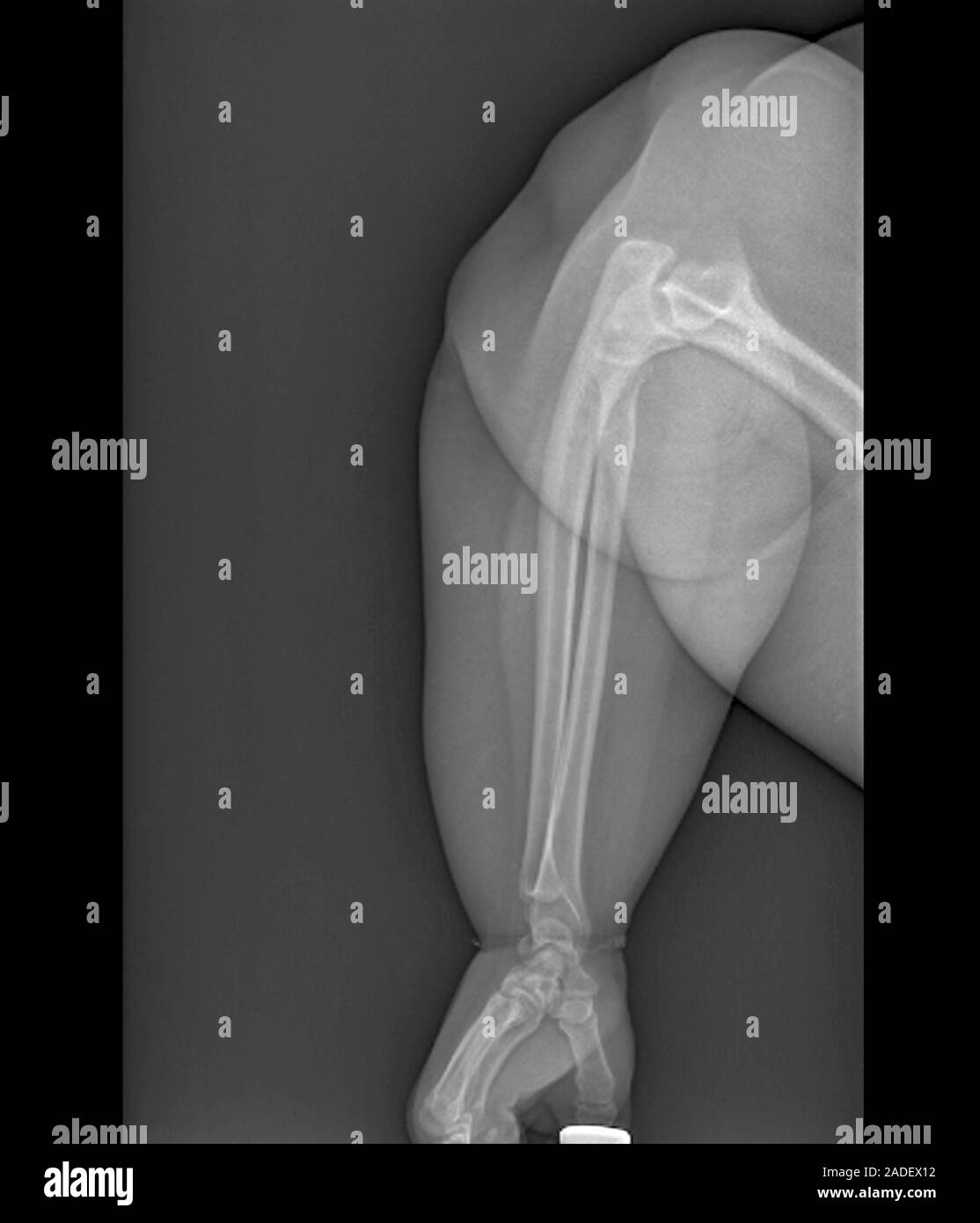 Oedema in obesity. X-ray of the right forearm of an obese 23 year-old ...