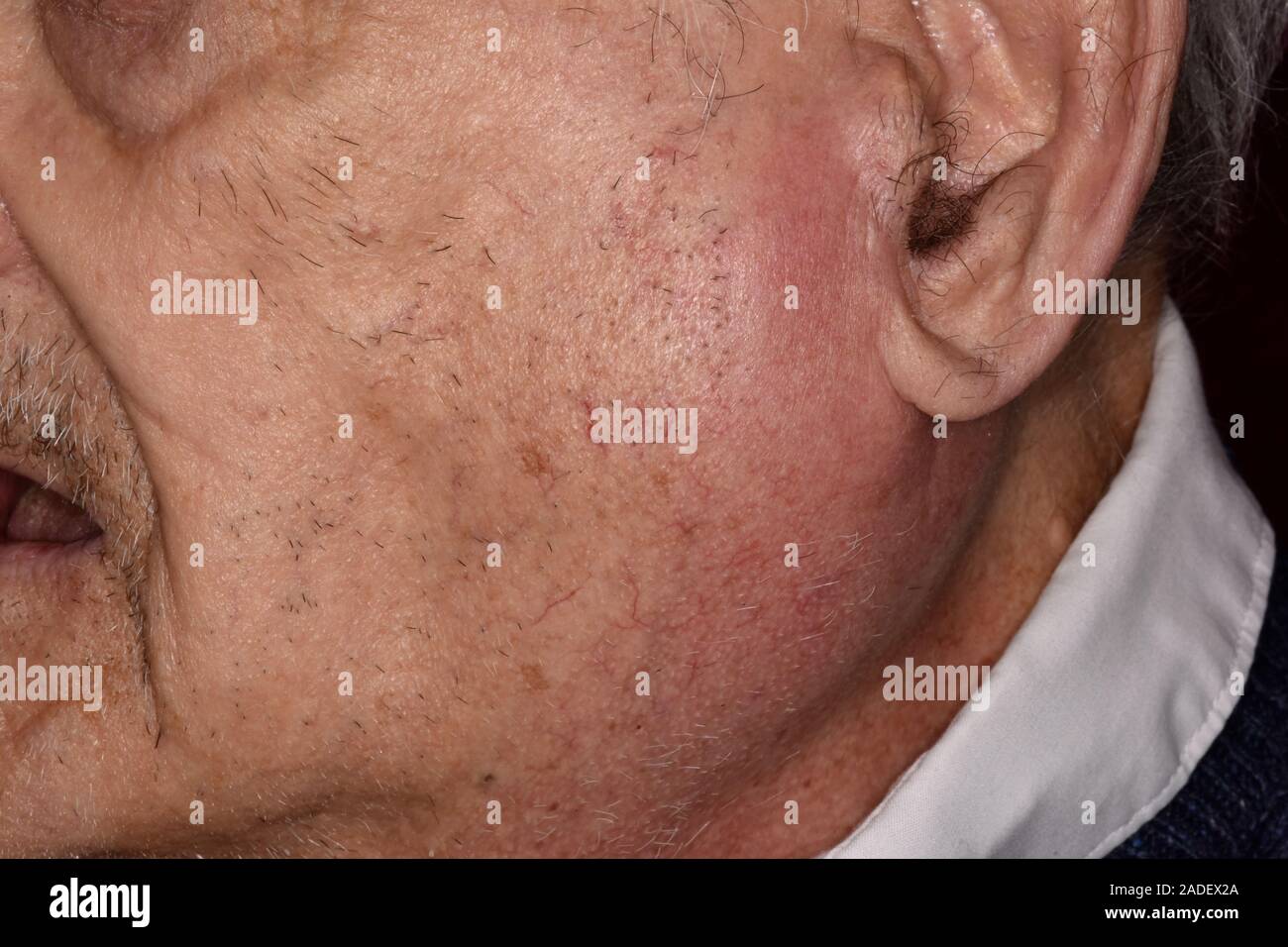 MODEL RELEASED. Inflamed salivary gland. 92-year-old man with acute ...