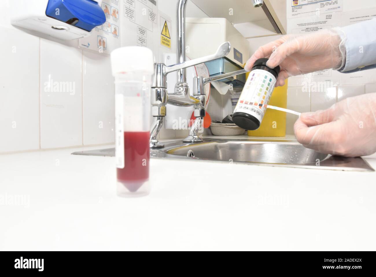 MODEL RELEASED. Testing for blood in a urine sample. Test stick being ...