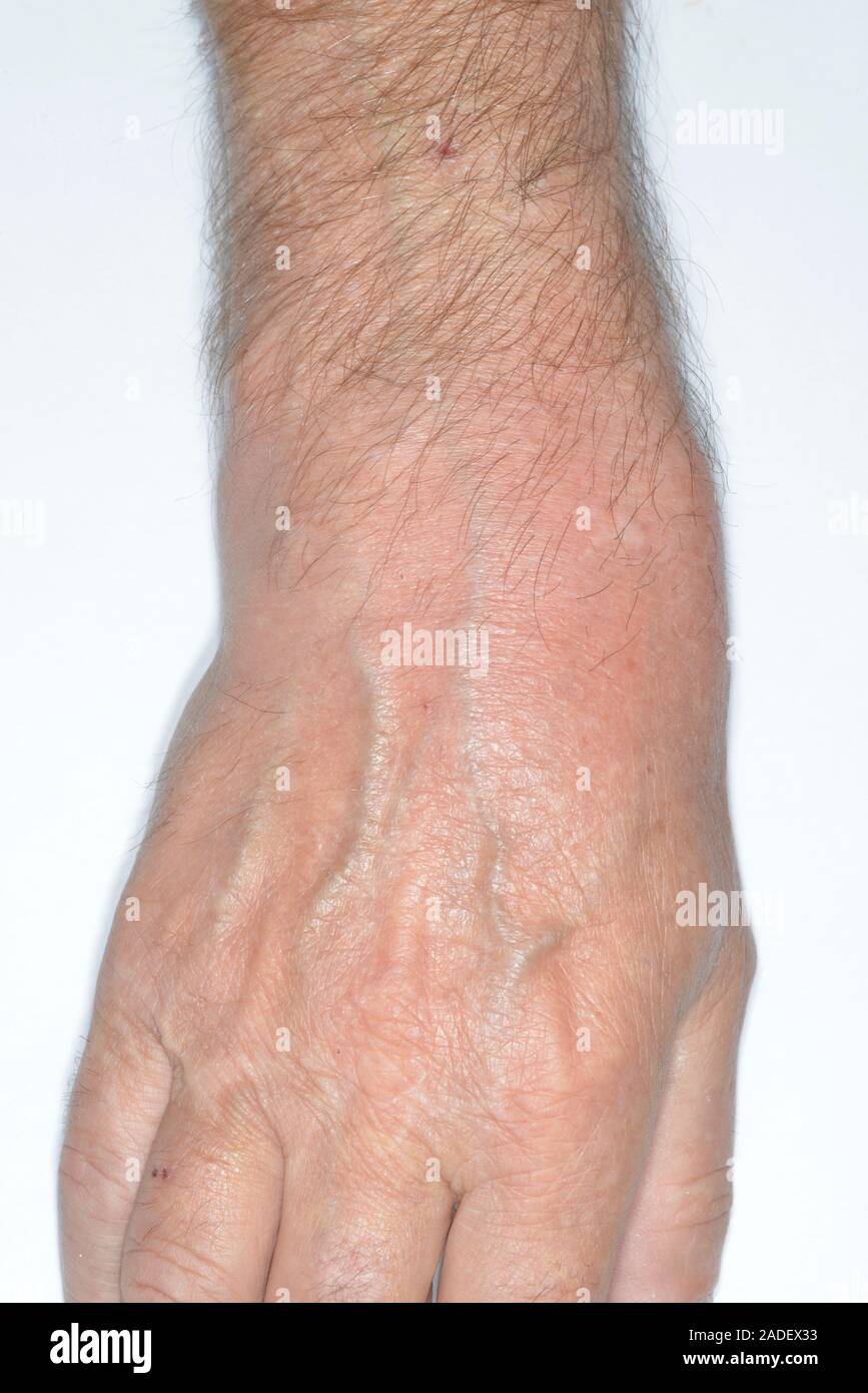 MODEL RELEASED. Cellulitis on the wrist of a 56-year-old man ...
