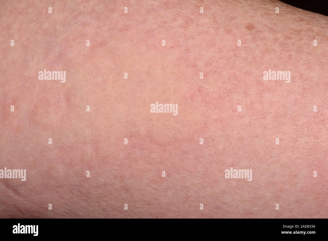 MODEL RELEASED. Urticaria rash on the skin of the arm of a 65-year-old ...