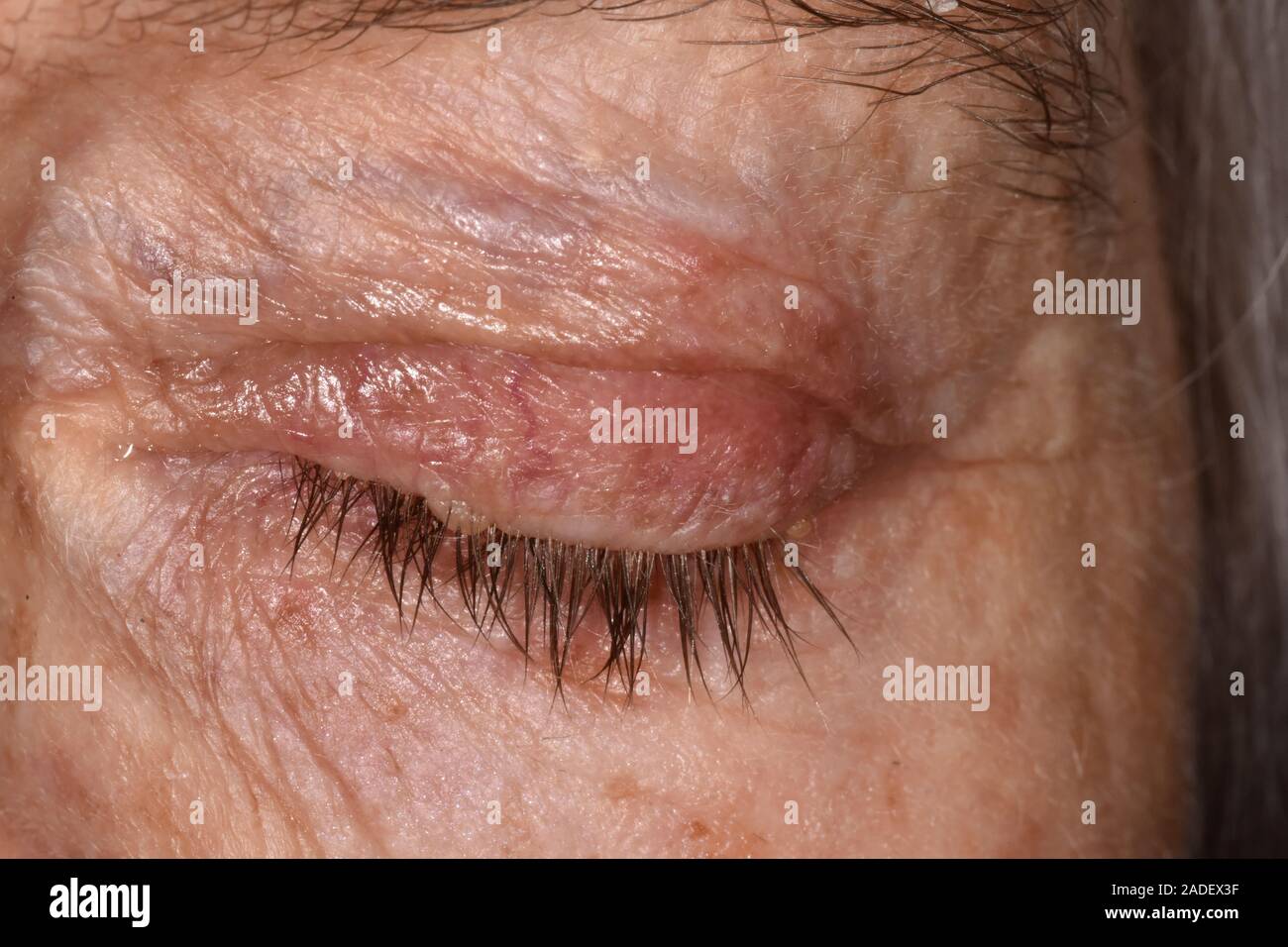 MODEL RELEASED. Eczema affecting the skin around a 71-year-old woman's ...