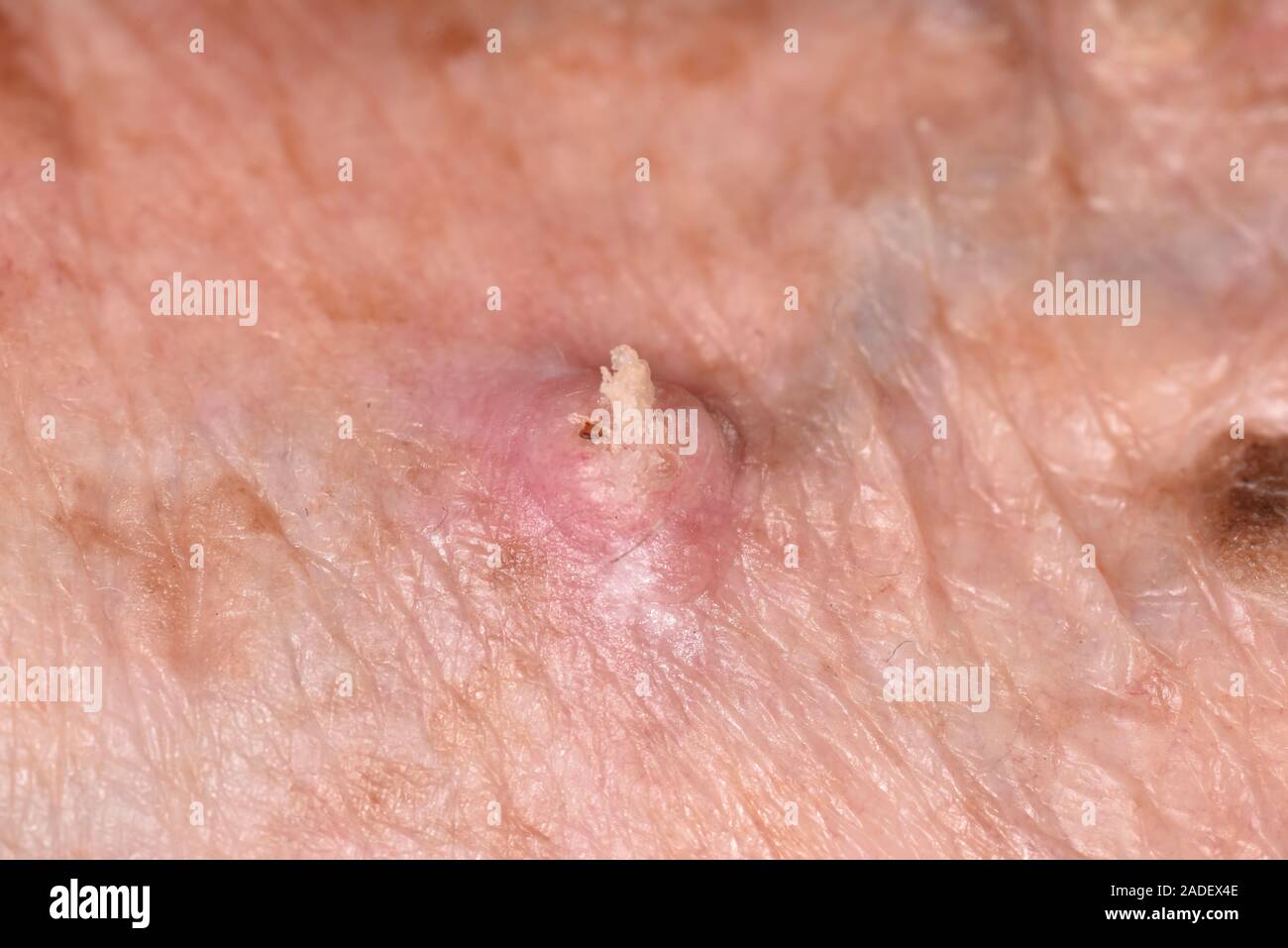 MODEL RELEASED. Keratoacanthoma on the skin of an 83-year-old woman ...
