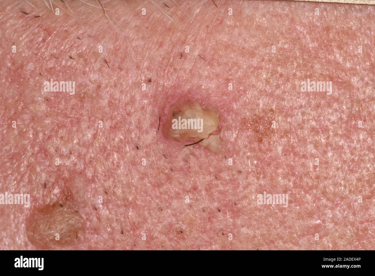 MODEL RELEASED. Solar keratosis growth on the skin of a 90-year-old man ...
