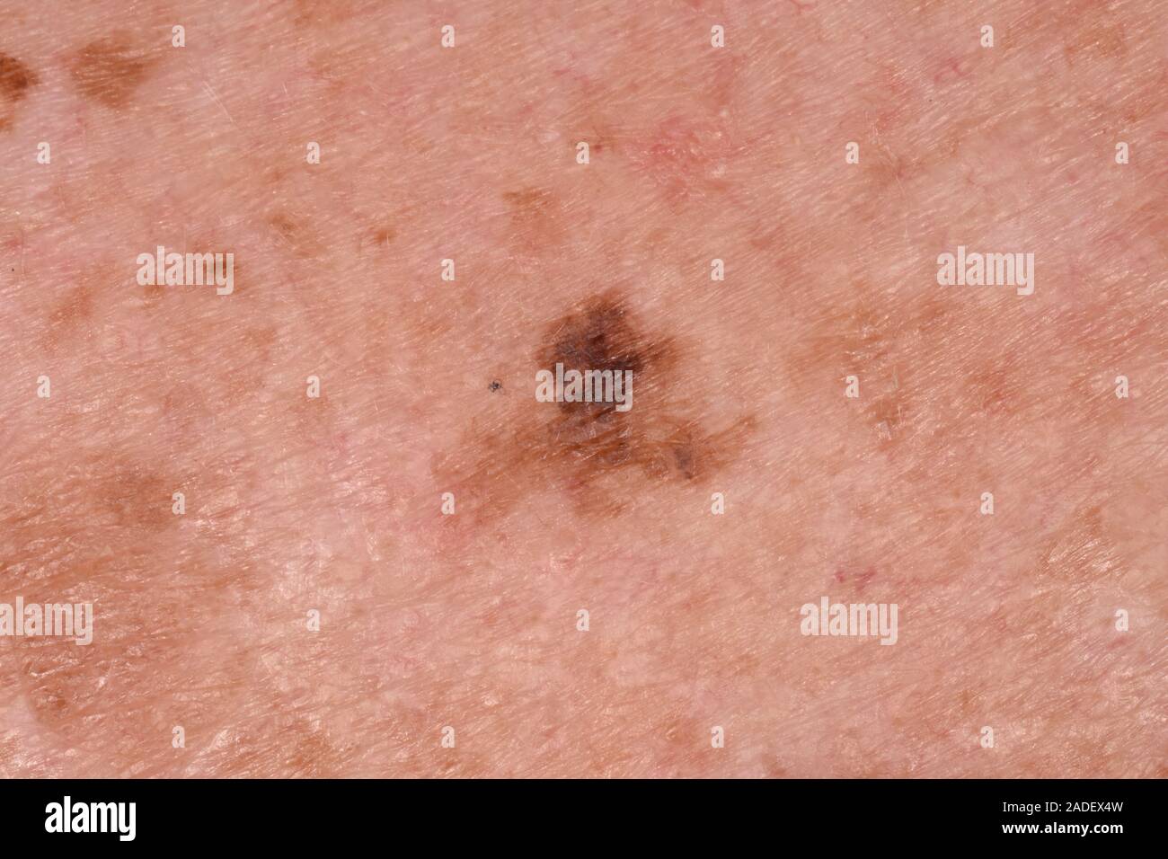 Junctional Melanocytic Nevus