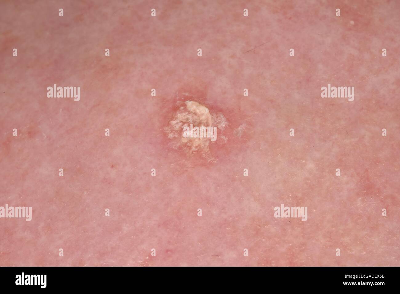MODEL RELEASED. Solar keratosis growth on the scalp of a 93-year-old ...
