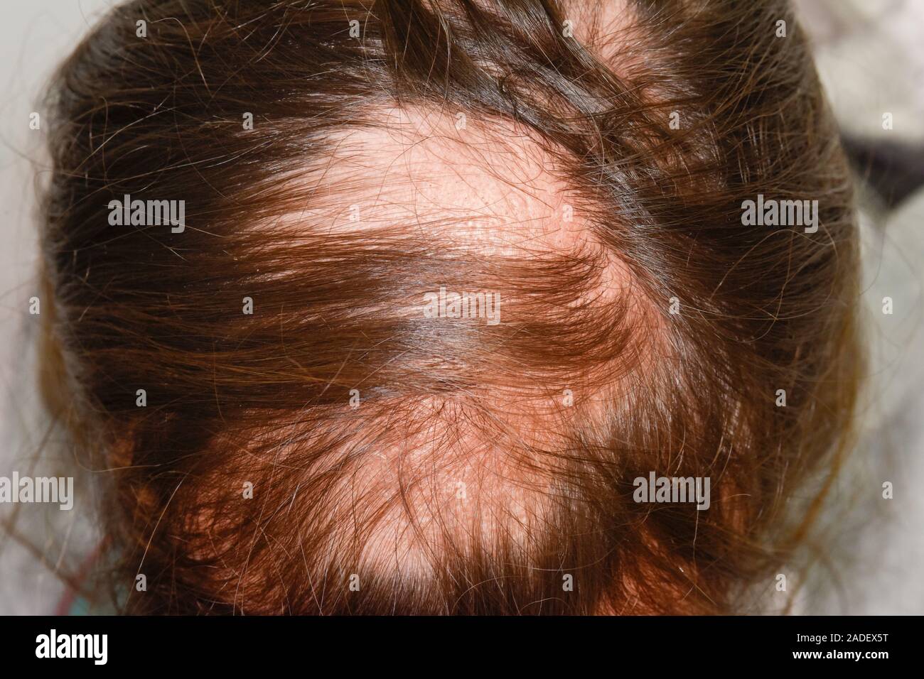 MODEL RELEASED. Spot baldness. Bald patch on the scalp of a 44-year-old ...