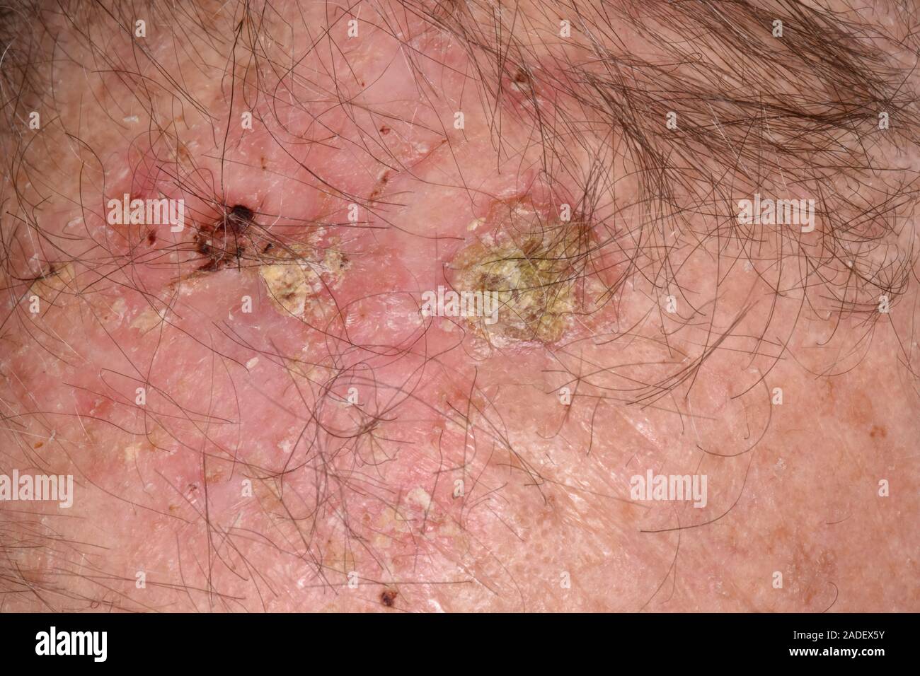 MODEL RELEASED. Solar keratosis growths on the scalp of a 74-year-old ...
