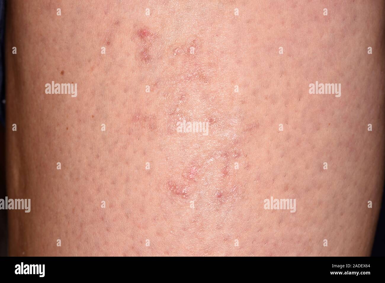 MODEL RELEASED. Linear porokeratosis rash on the skin of the calf of a ...