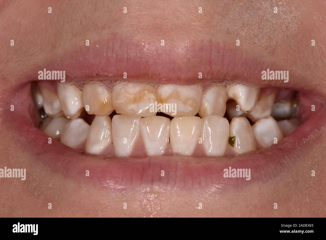 MODEL RELEASED. Fluorosis. Brown staining of an 11-year-old boy's tooth ...