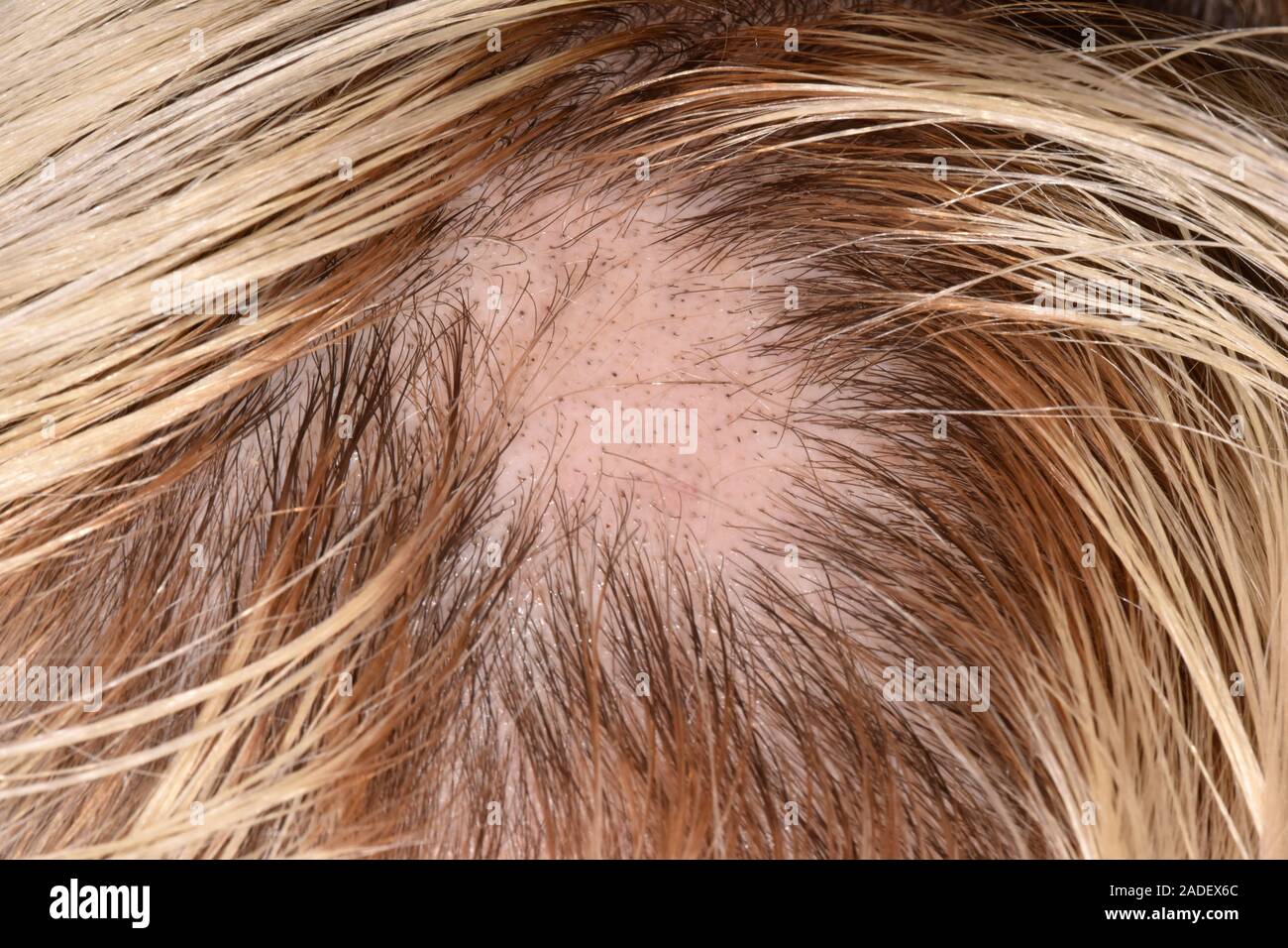 MODEL RELEASED. Spot baldness. Bald patch on the scalp of a 44-year-old ...