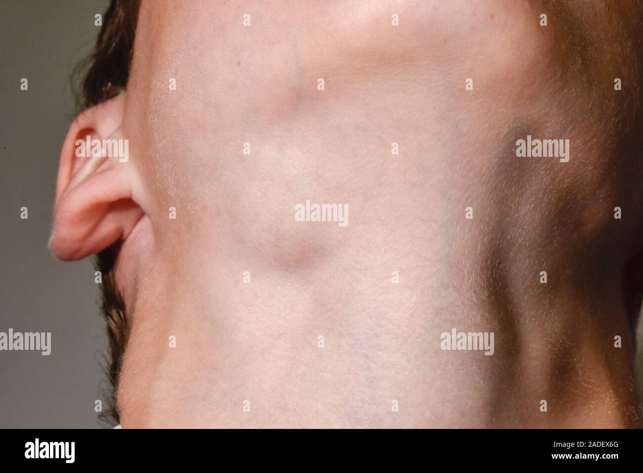 MODEL RELEASED. Salivary gland calculus showing as a swelling in the ...