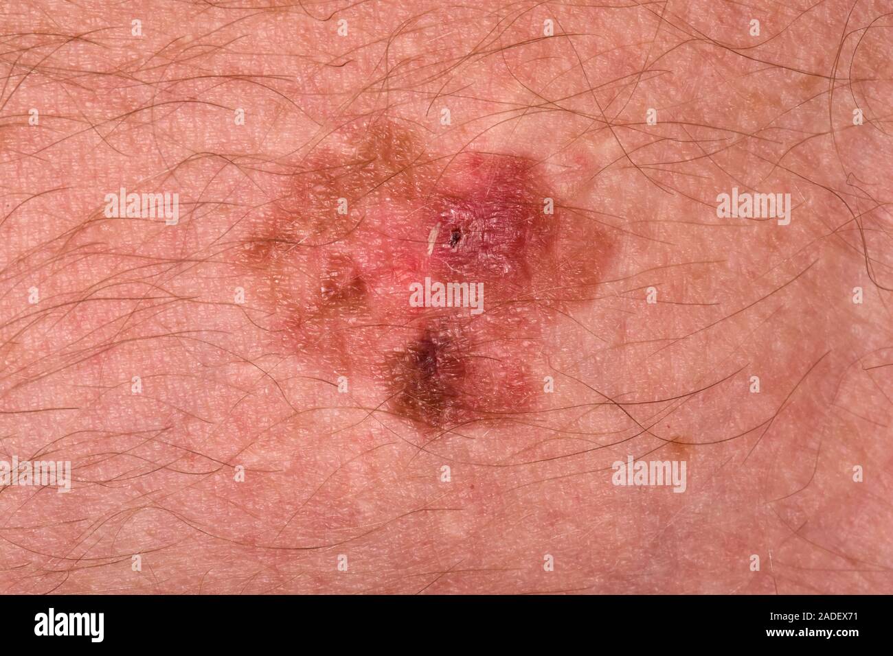 MODEL RELEASED. Lentigo maligna melanoma on the skin of the arm of a 68 ...