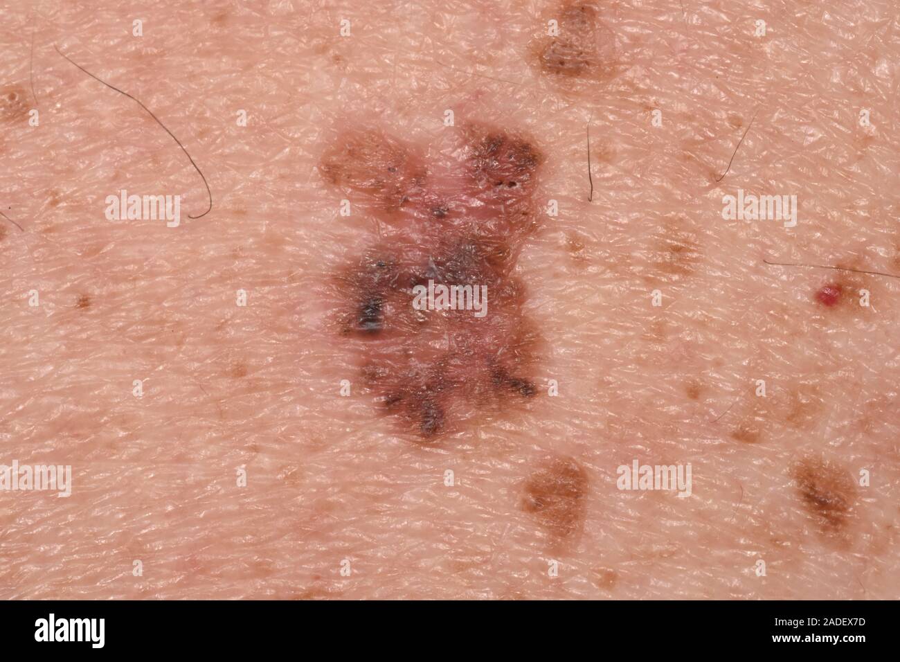 MODEL RELEASED. Basal cell carcinoma on the skin of a 71-year-old man ...