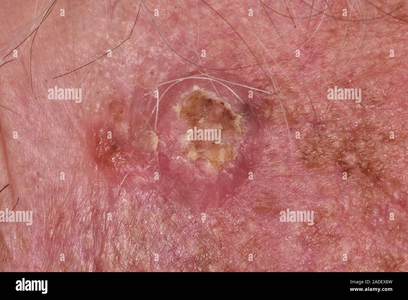 MODEL RELEASED. Basal cell carcinoma on the skin in front of the ear of ...