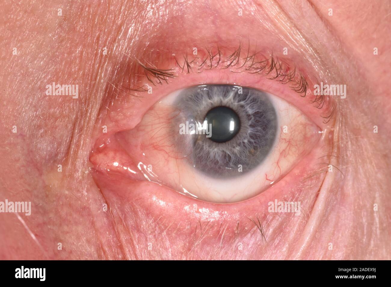 MODEL RELEASED. Pterygium growth (centre left) on a 65-year-old man's ...
