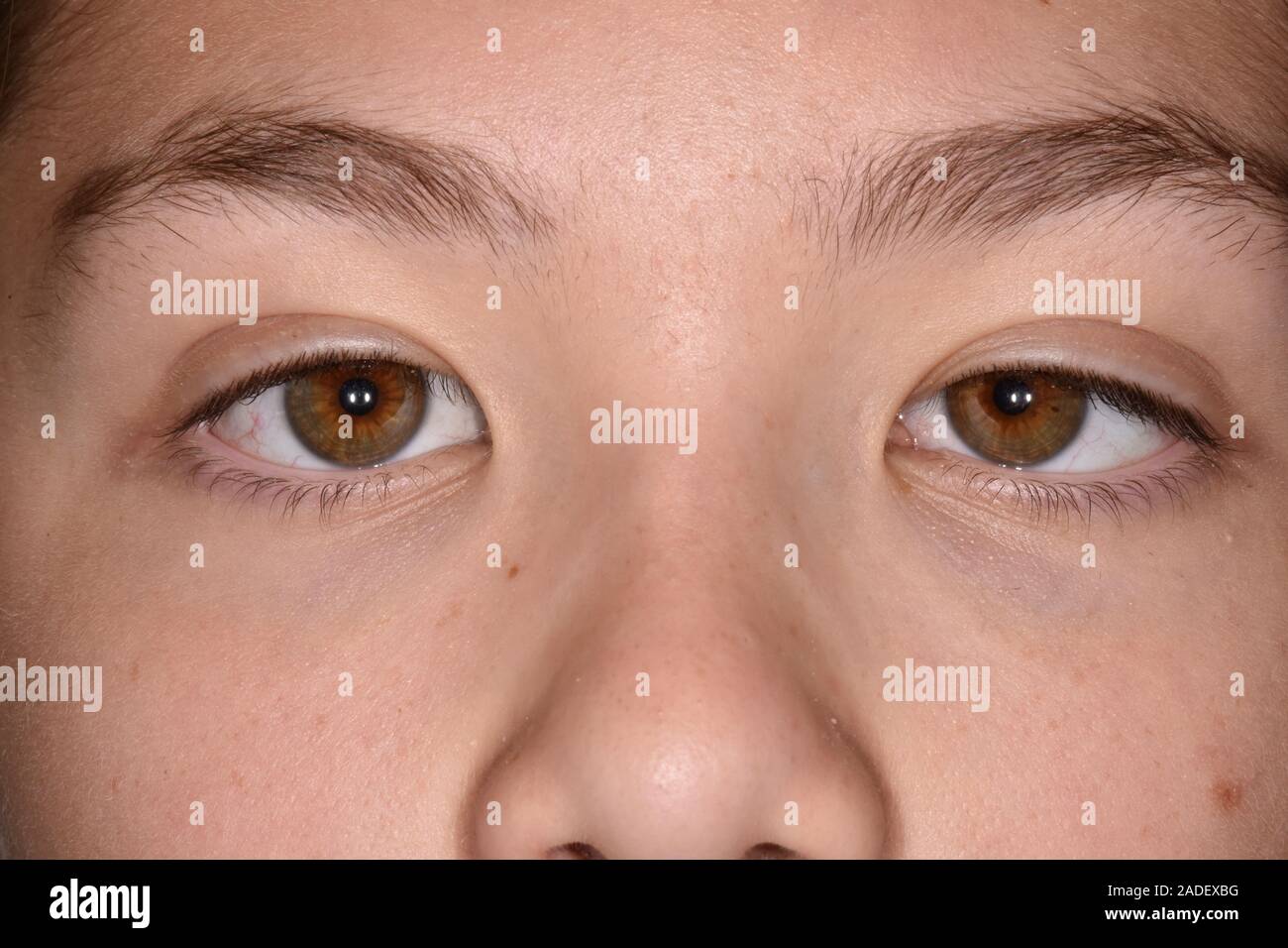 MODEL RELEASED. Strabismus. Close-up of the left eye of a 12-year-old ...