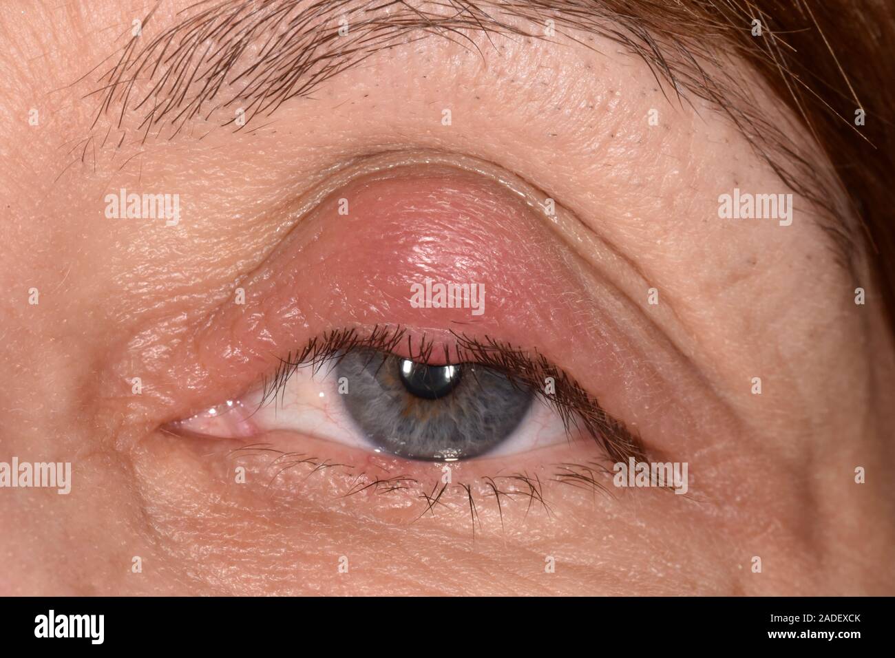 MODEL RELEASED. Chalazion cyst on an eyelid in a 54-year-old woman ...