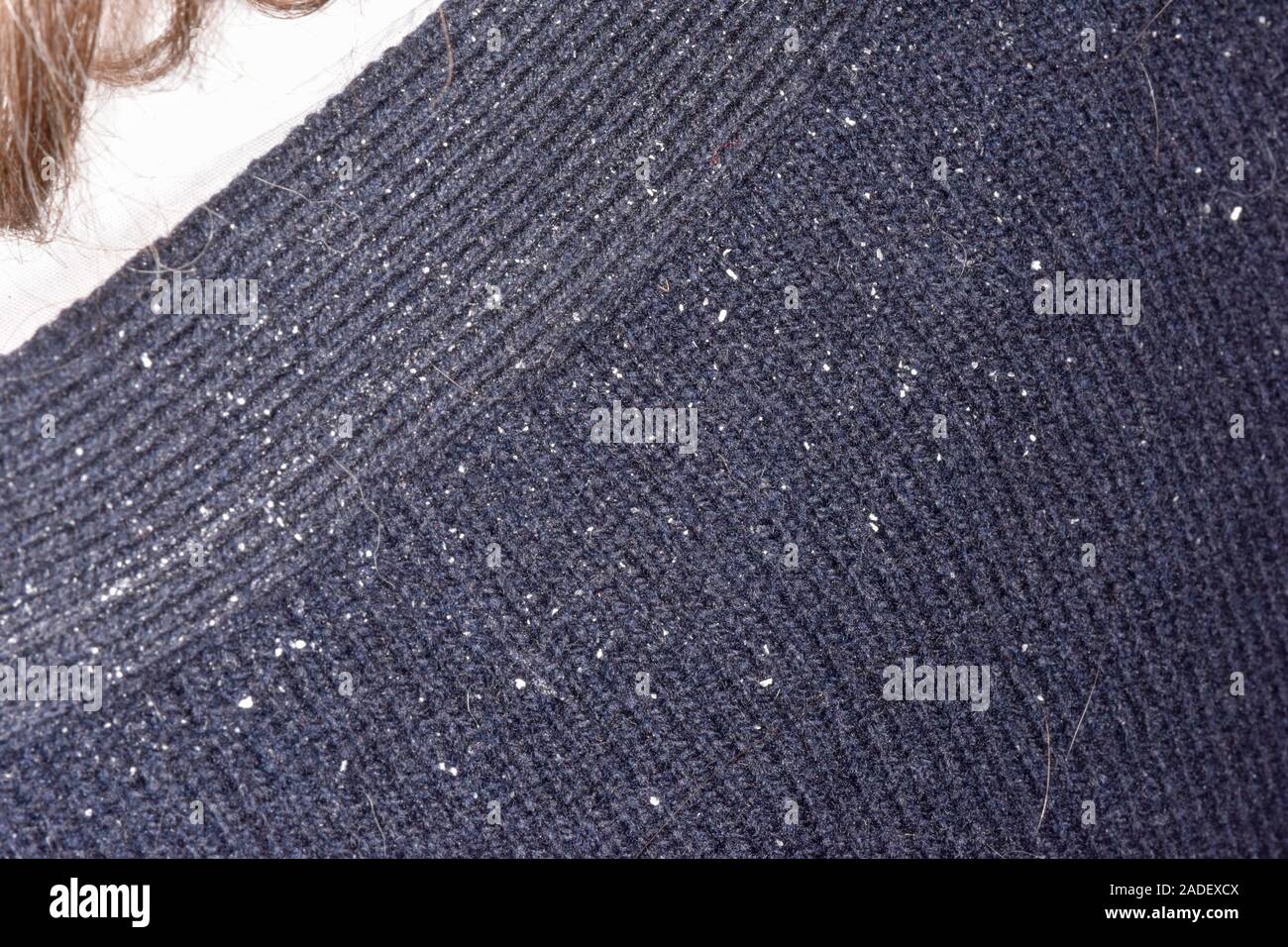 MODEL RELEASED. Skin flakes from scalp psoriasis affecting an 80-year ...