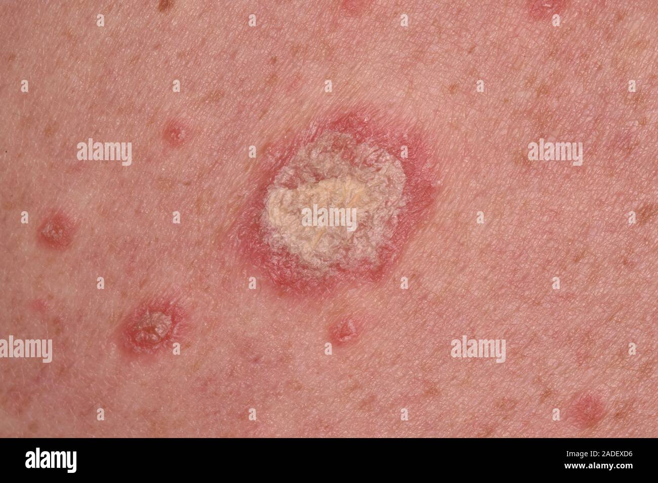 MODEL RELEASED. Plaque psoriasis affecting the skin of a 44-year-old ...