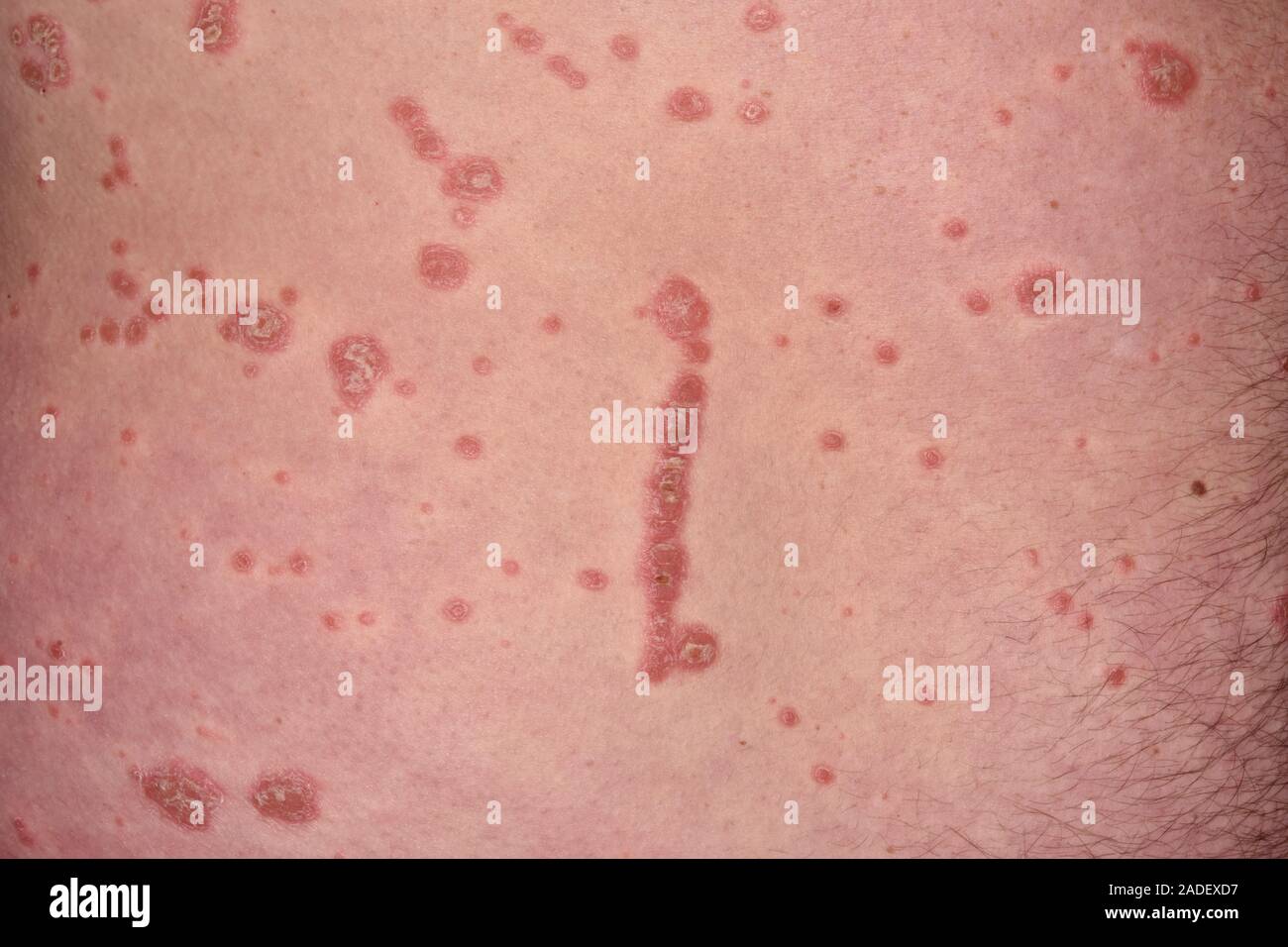 MODEL RELEASED. Plaque psoriasis affecting the skin of a 44-year-old ...