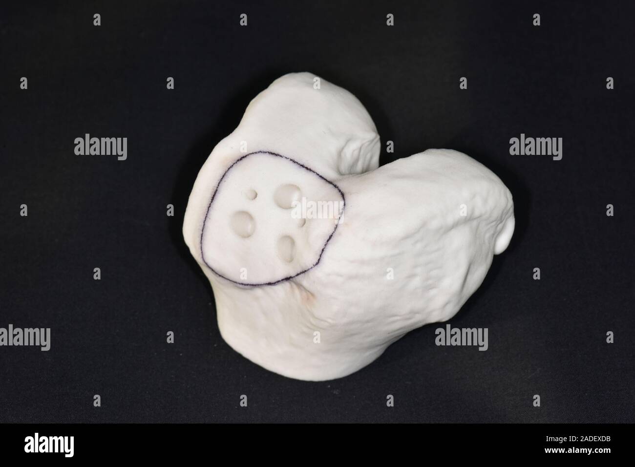 Knee replacement model. This model is used by the orthopaedic surgeons ...