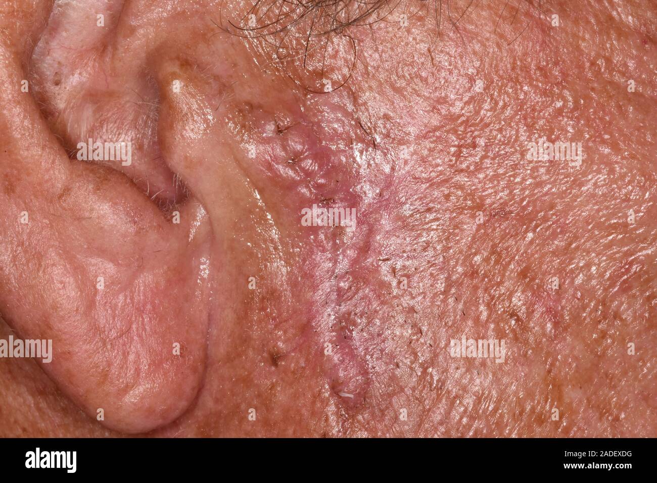MODEL RELEASED. Scar after basal cell carcinoma excision from near the ...