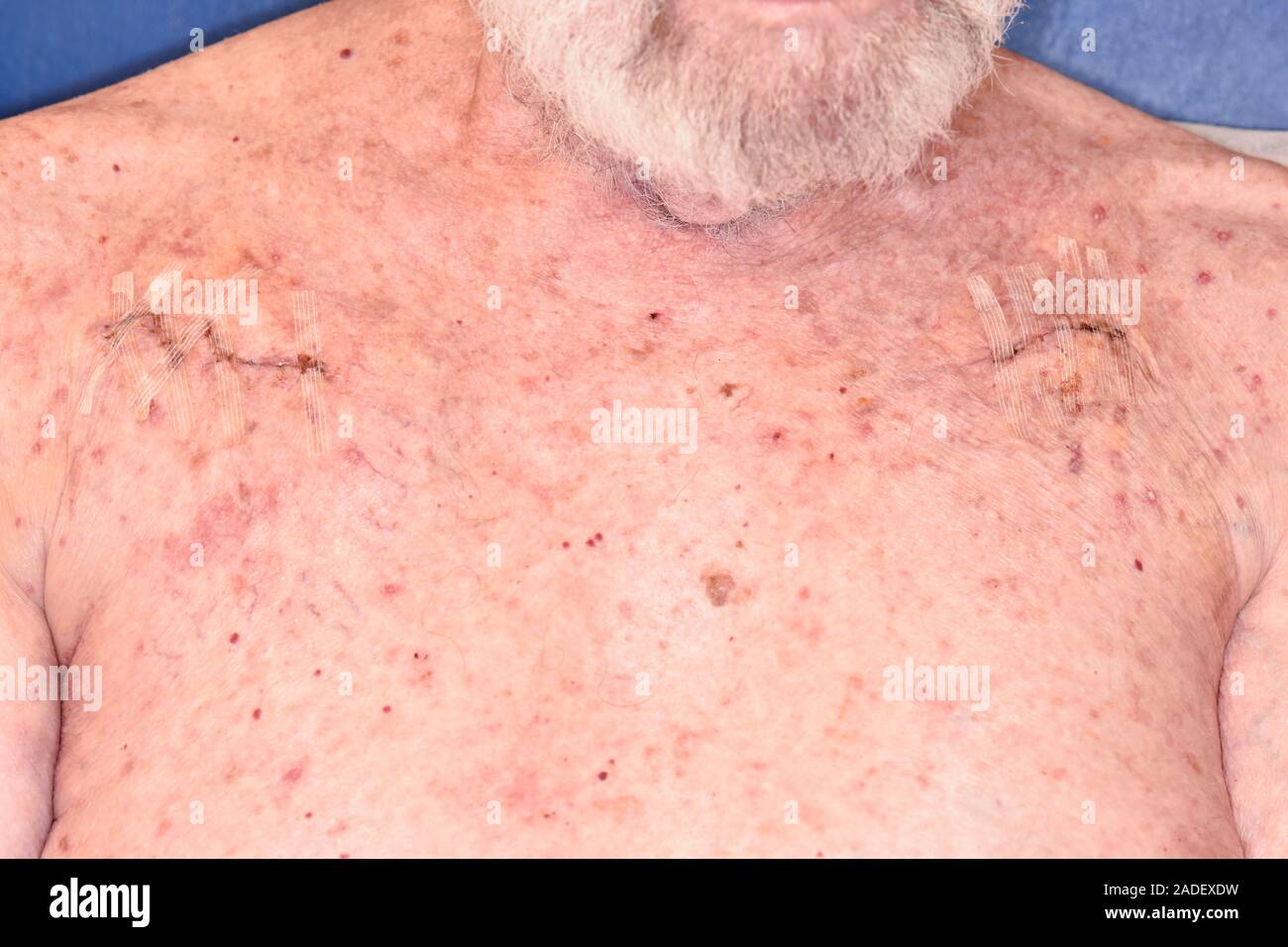 MODEL RELEASED. Pacemaker insertion scars on the chest of an 87-year ...