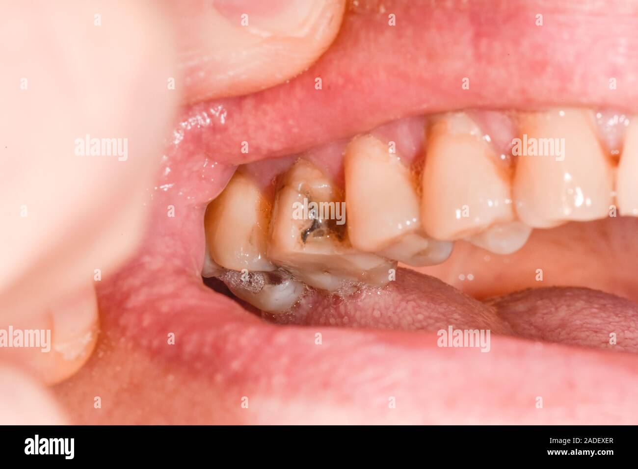 MODEL RELEASED. Broken molar tooth in a 57-year-old man Stock Photo - Alamy