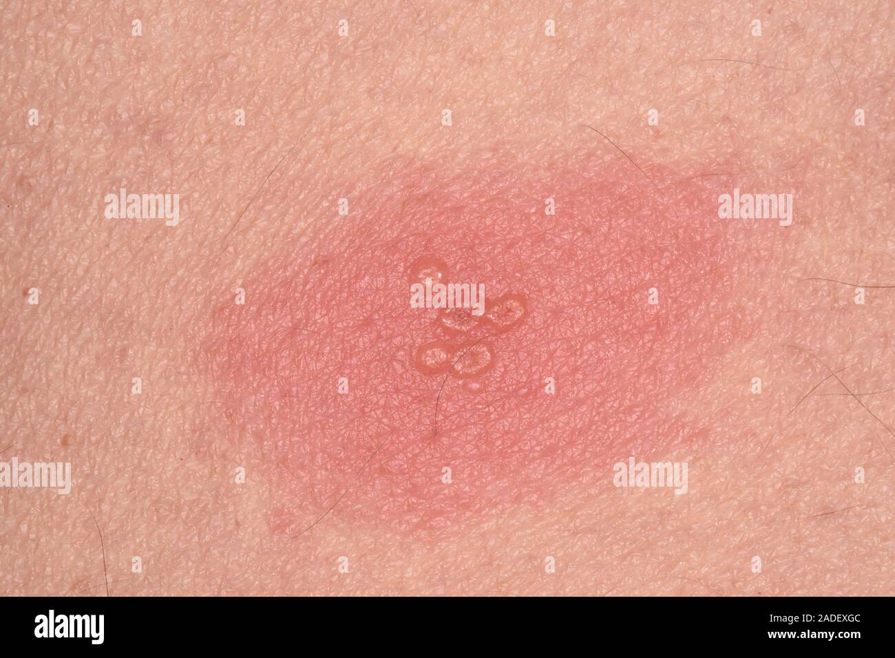 MODEL RELEASED. Shingles rash and lesions on the skin of a 65-year-old ...