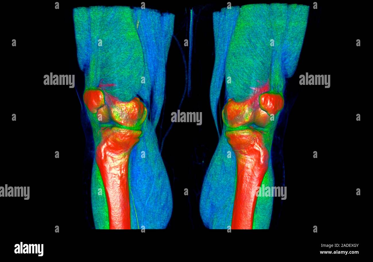 Knee joints and muscles. 3D computed tomography (CT) scan of the ...