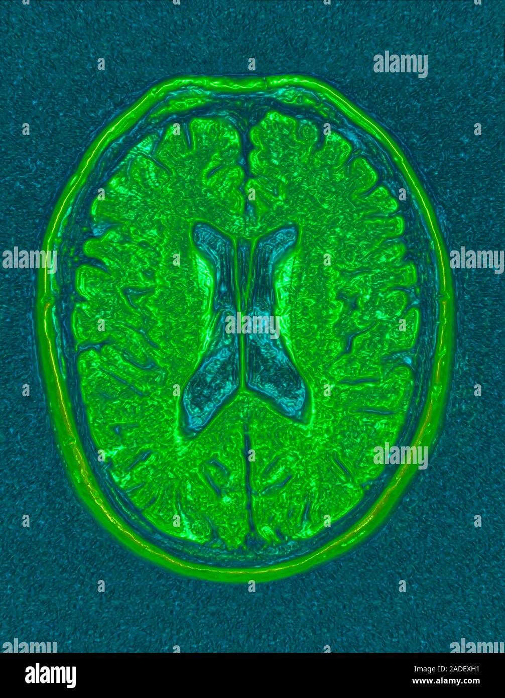 Human brain, coloured axial magnetic resonance imaging (MRI) scan. This view shows the brain's ...