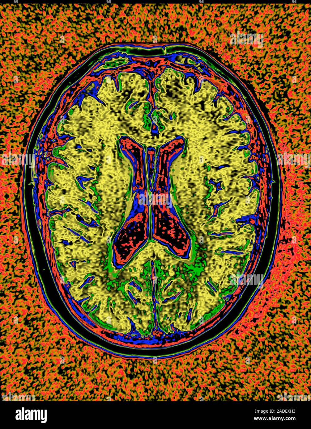Human brain, coloured axial magnetic resonance imaging (MRI) scan. This view shows the brain's ...