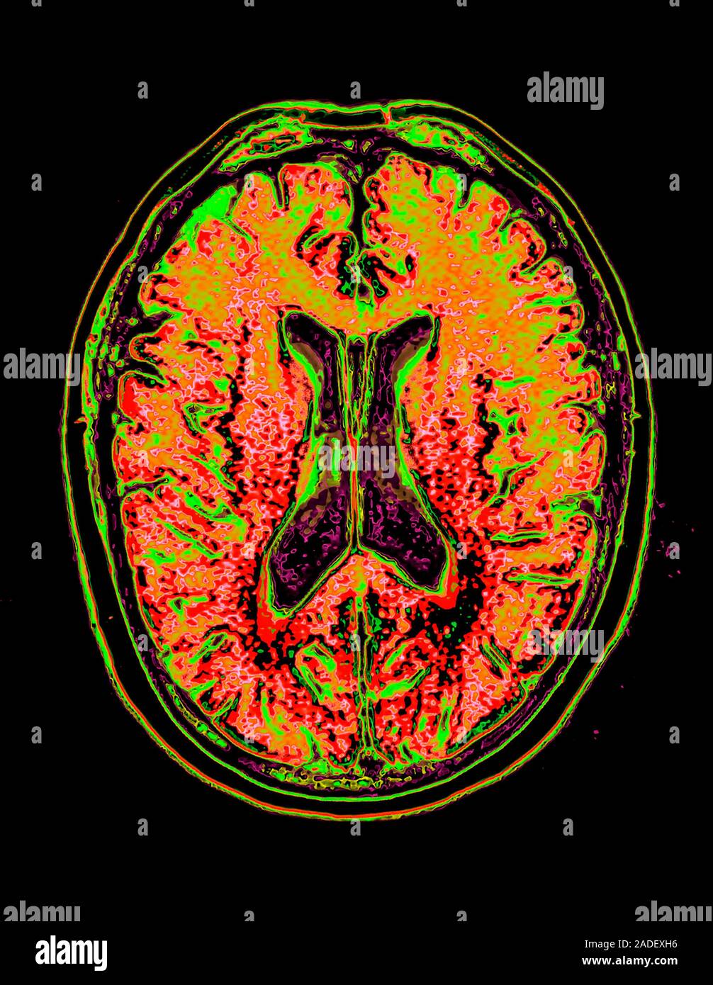 Human brain, coloured axial magnetic resonance imaging (MRI) scan. This view shows the brain's ...