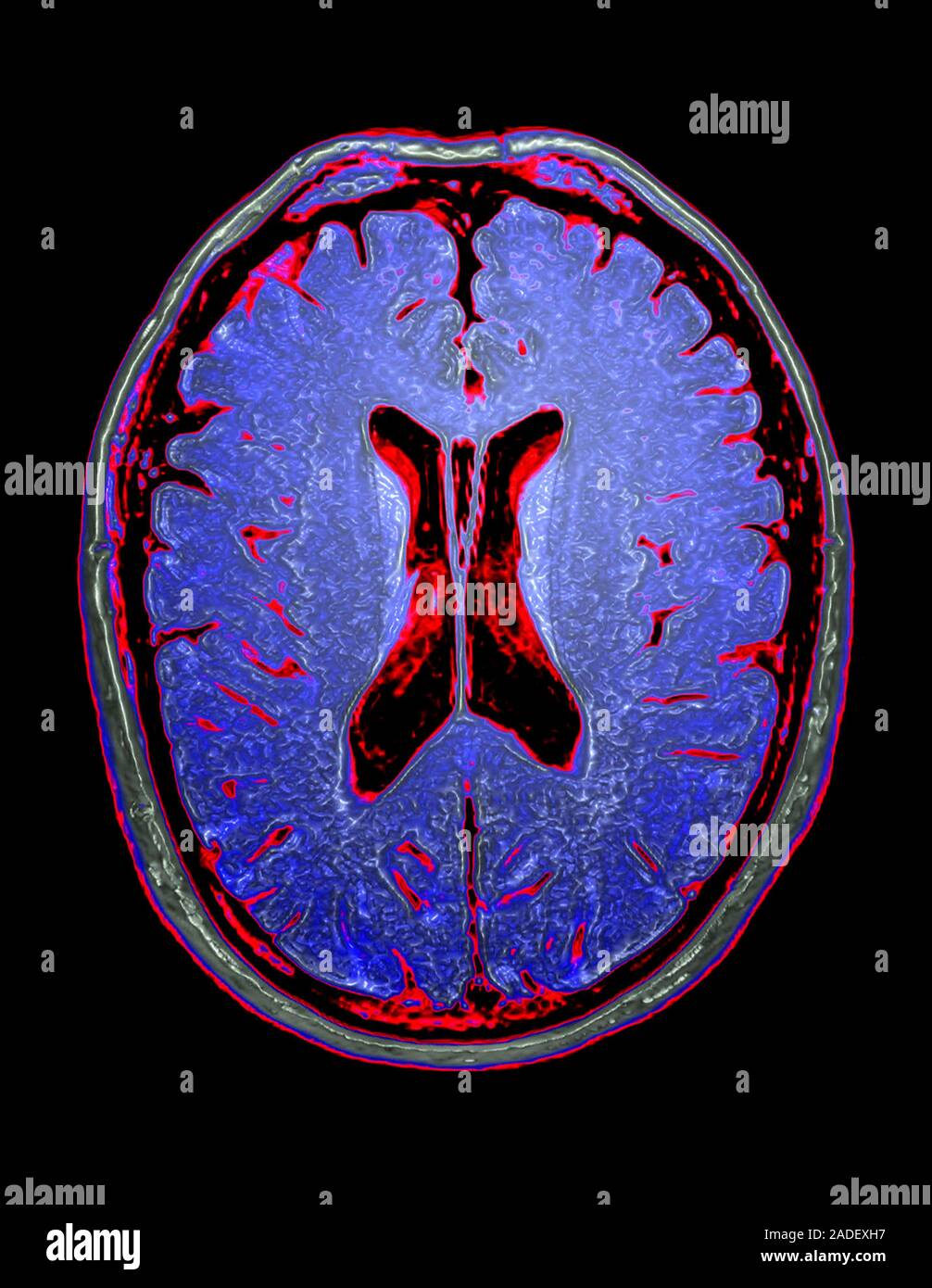 Human brain, coloured axial magnetic resonance imaging (MRI) scan. This view shows the brain's ...
