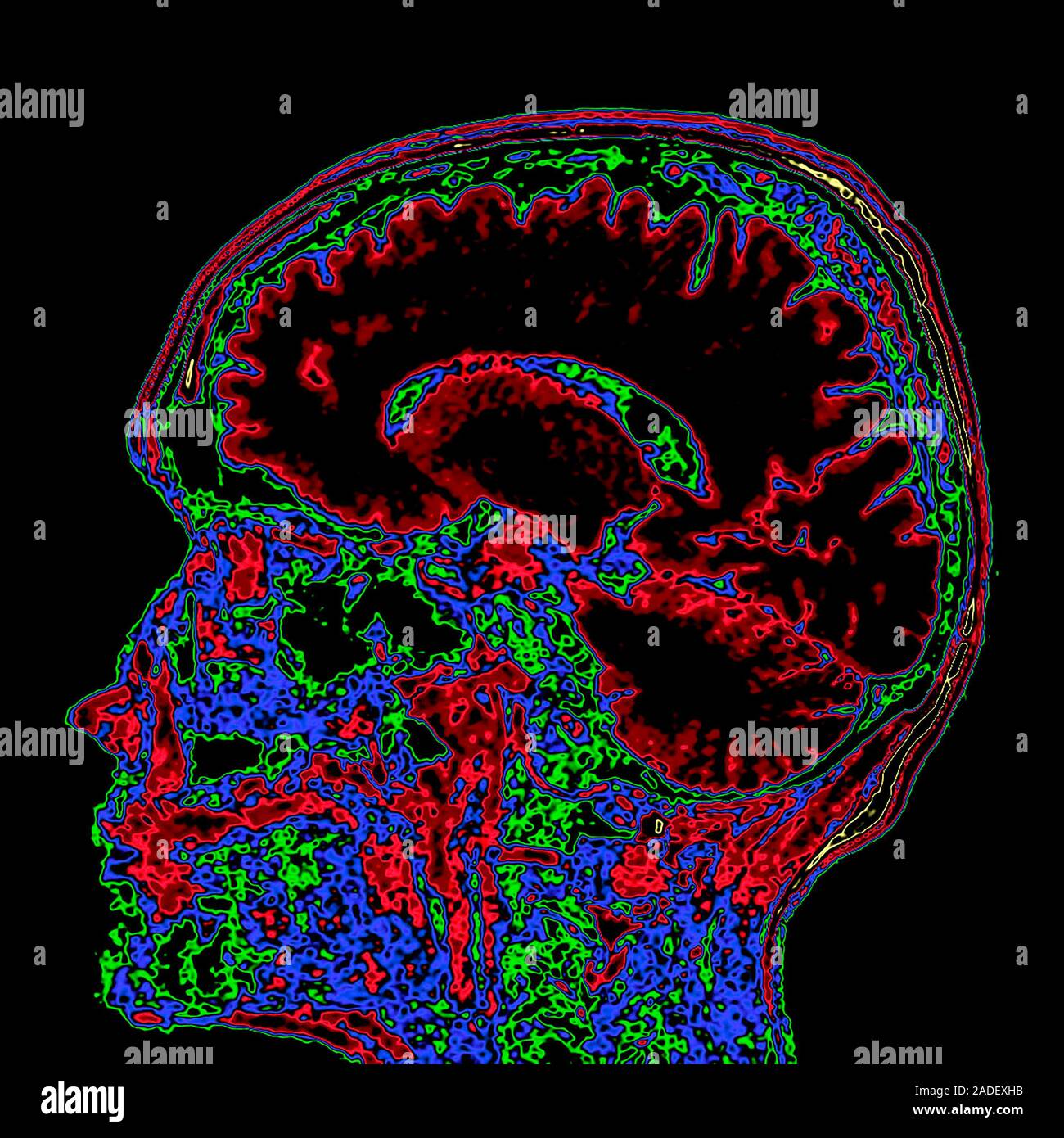 Human head and brain. Coloured sagittal magnetic resonance imaging (MRI) scan of a side view of ...