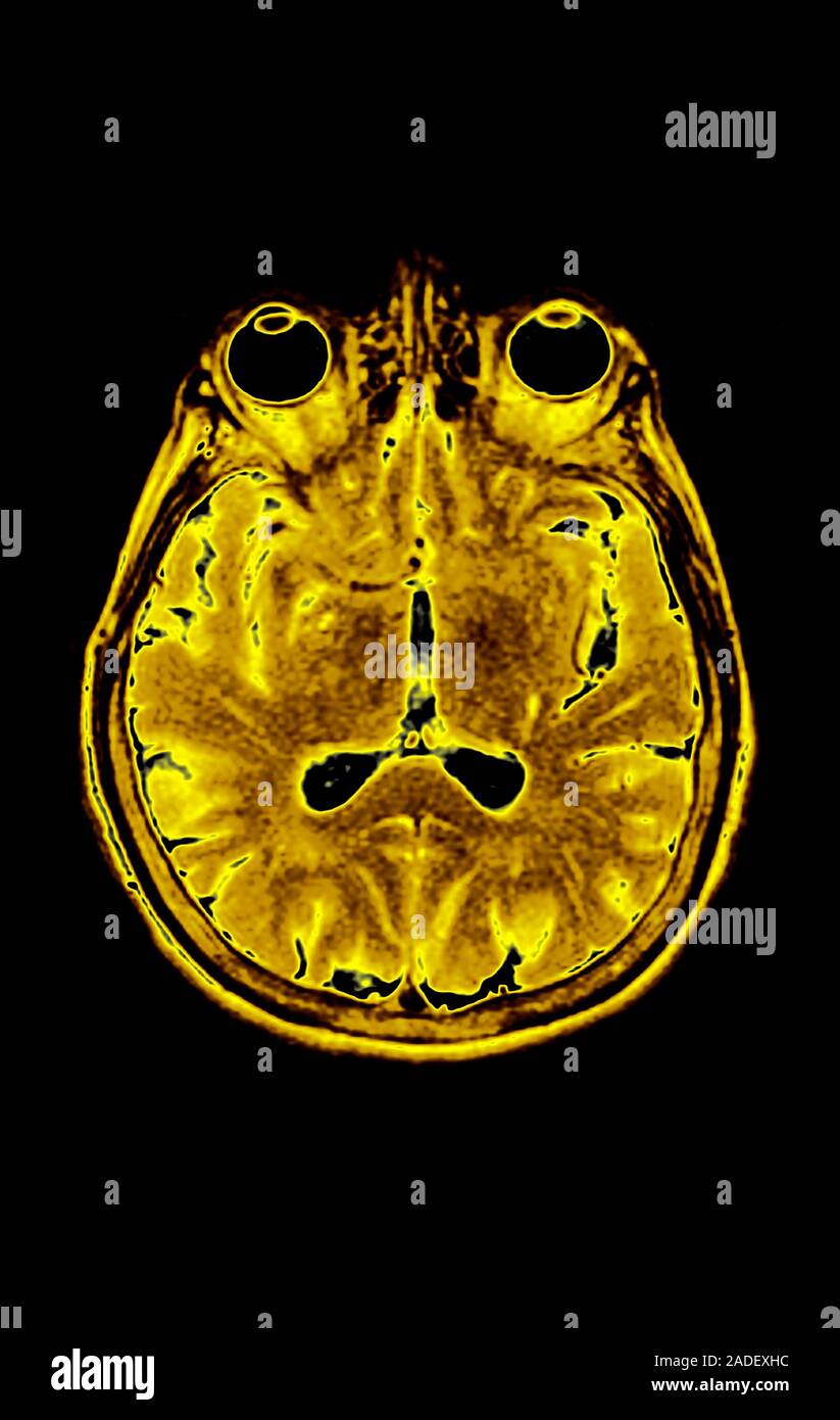 Human eyes and brain. Coloured axial magnetic resonance imaging (MRI) scan of the human brain ...