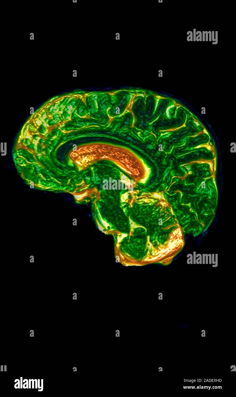Human brain. Coloured sagittal magnetic resonance imaging (MRI) scan of ...