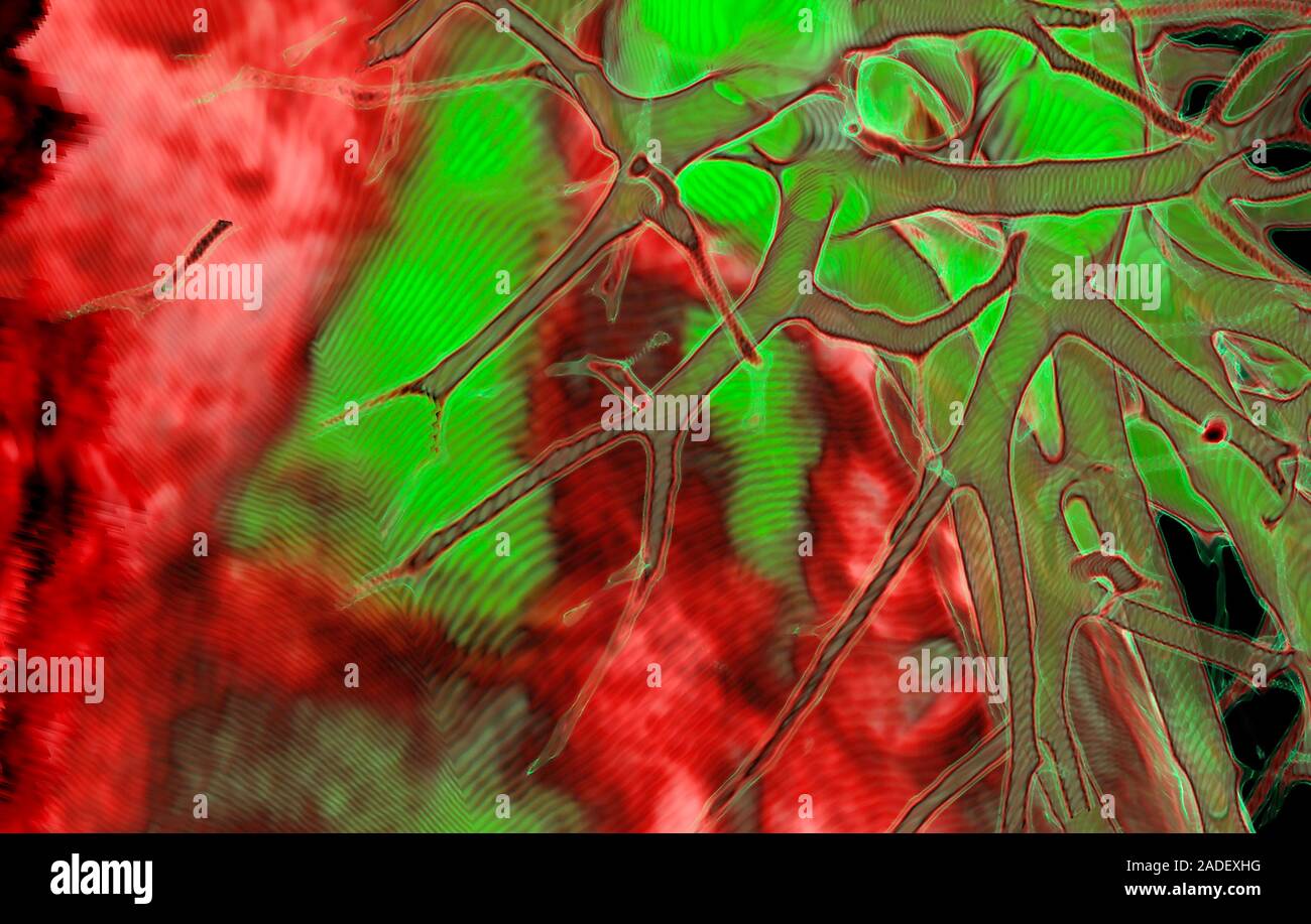 Lung airways, 3D coloured computed tomography (CT) scan. The lung ... Lung airways, 3D coloured computed tomography (CT) scan. The lung ...