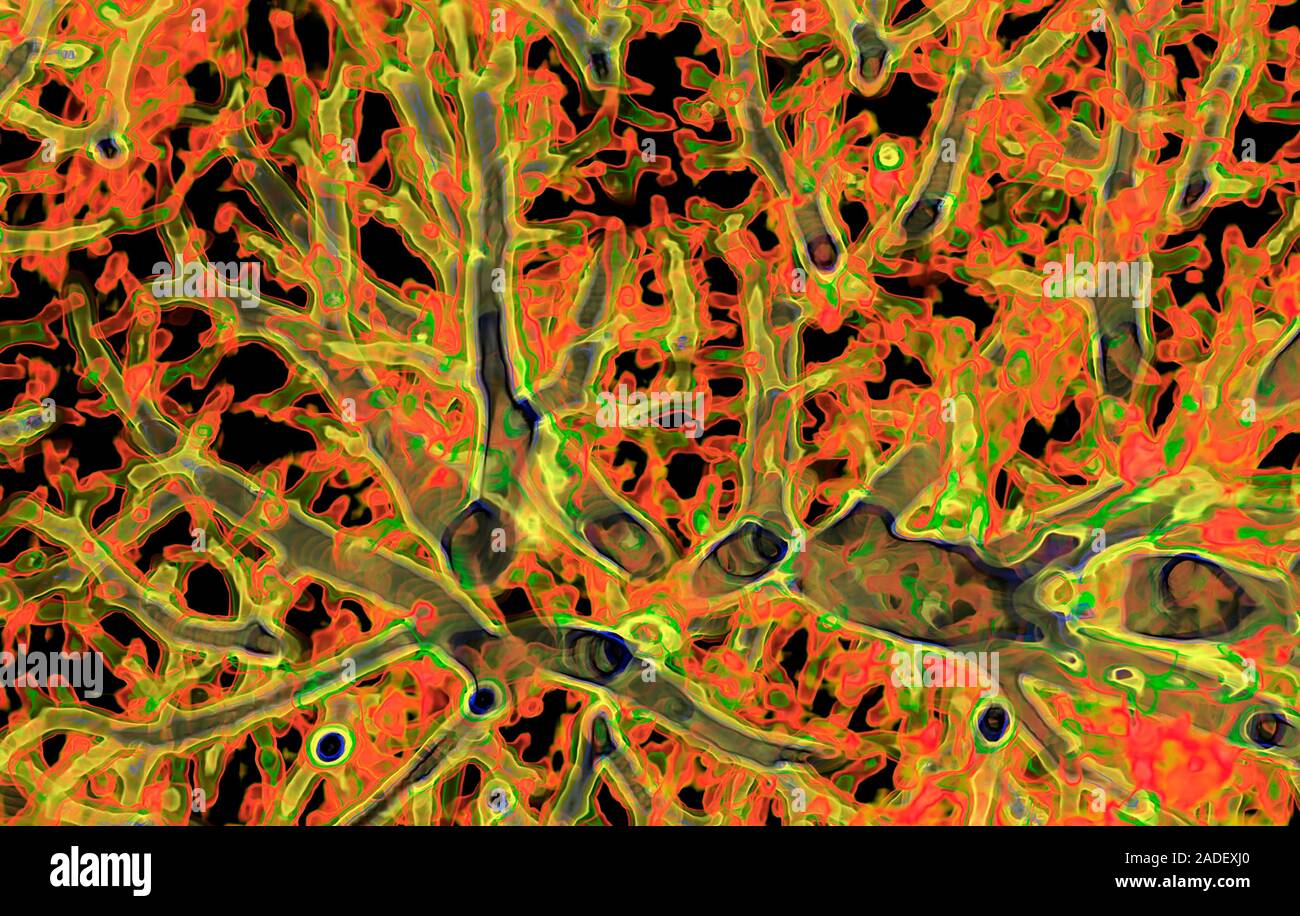 Lung airways, 3D coloured computed tomography (CT) scan. The lung ...